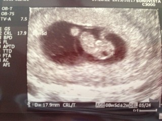 妊娠8w5dのエコー写真(ページ4)